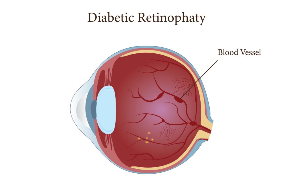 Diabetic Retinopathy - Health BeatHealth Beat