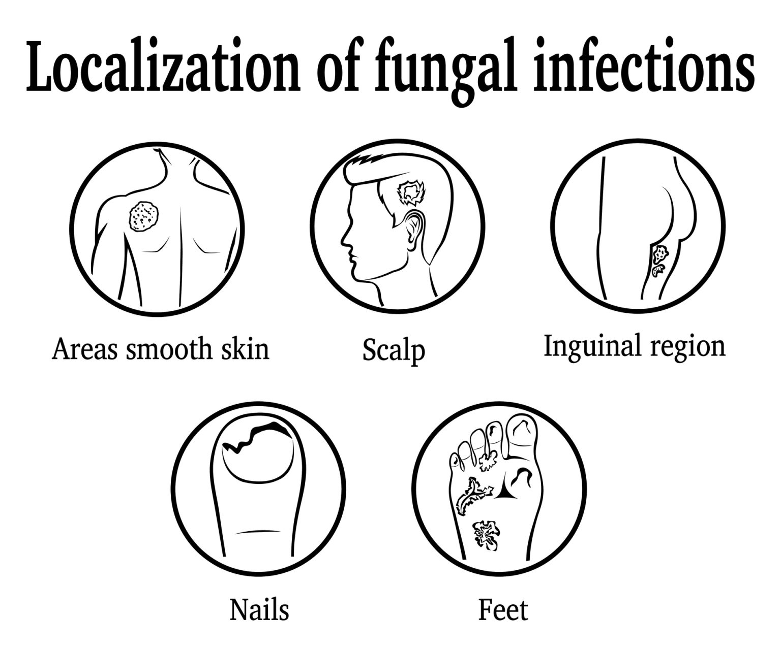 Signs of a Fungal Infection - Health BeatHealth Beat