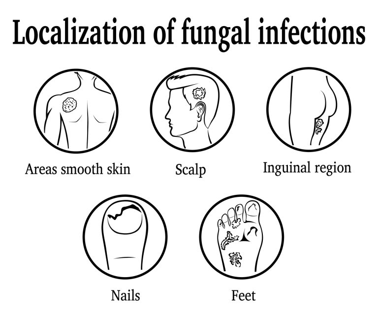 Signs of a Fungal Infection - Health BeatHealth Beat
