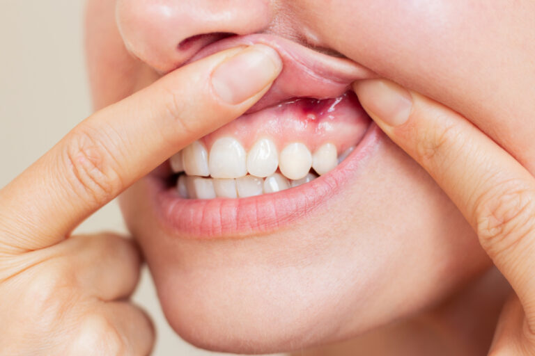 Stomatitis - Health BeatHealth Beat